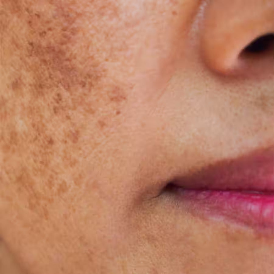 Hyper Pigmentation – Your Dr A®